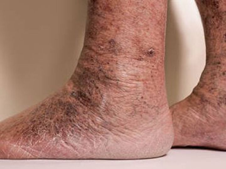 Clinic Package ENDOVENOUS RADIOFREQUENCY ABLATION (RFA) by Varicose ...