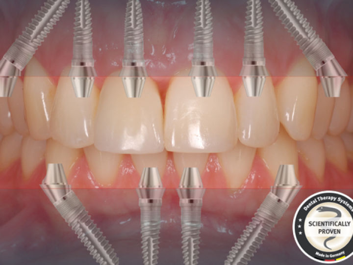 Clinic Package fast&fixed (bredent - Germany) by Implant Studio Clinic ...