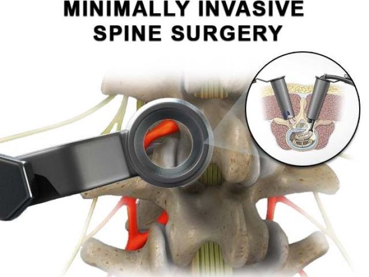 Clinic Package Minimally Invasive Spine Surgery in NYC by Pain ...